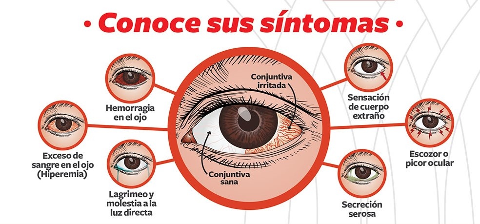 Como Prevenirte De La Conjuntivitis